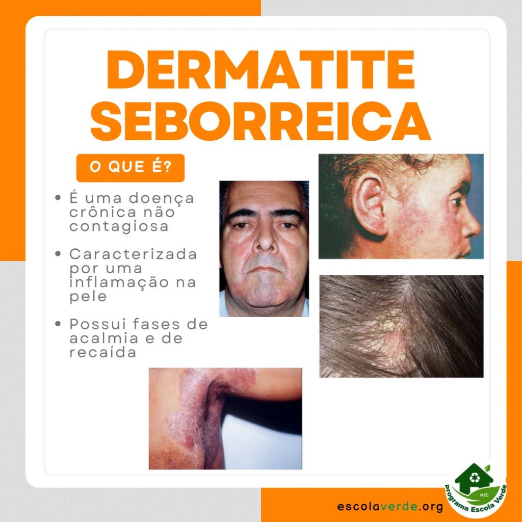 O QUE É A DERMATITE SEBORREICA? É UMA DOENÇA CONTAGIOSA? 💆🏽 – Programa ...